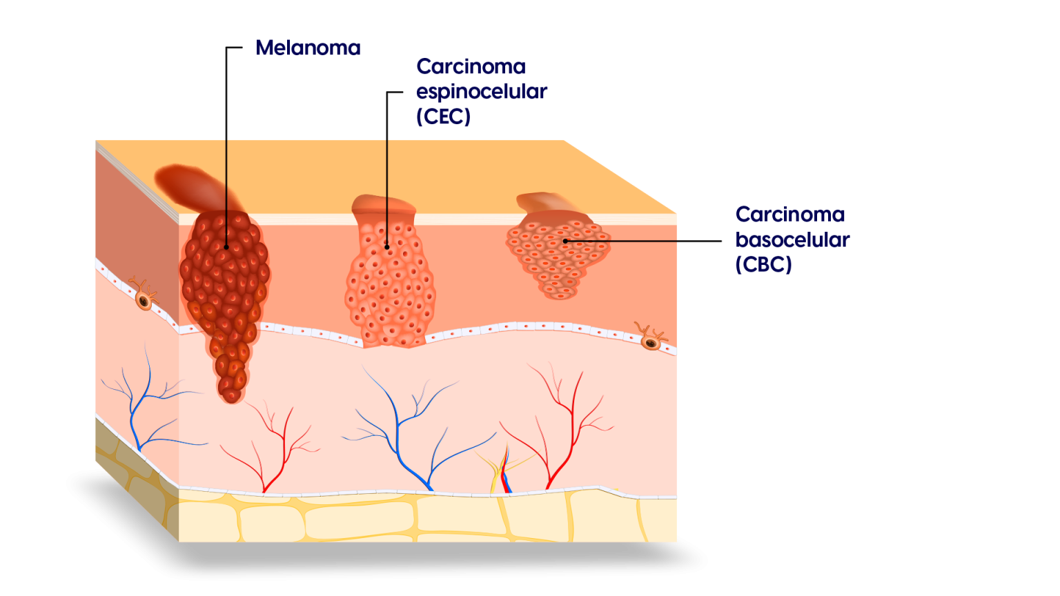 O que é câncer de pele? - Omint - Portal 360º